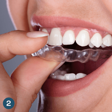 Clear Teeth Aligners, Invisible Braces Cost in India – Smiles.ai