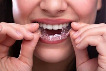 Clear Teeth Aligners, Invisible Braces Cost in India – Smiles.ai
